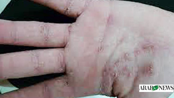 Scabies affects 6 more Al-Laith pupils; total 72 | Arab News PK
